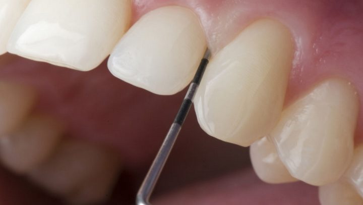 Parodontose Archive - Zahnarztpraxis Dr. Ahlvers & Ahlvers